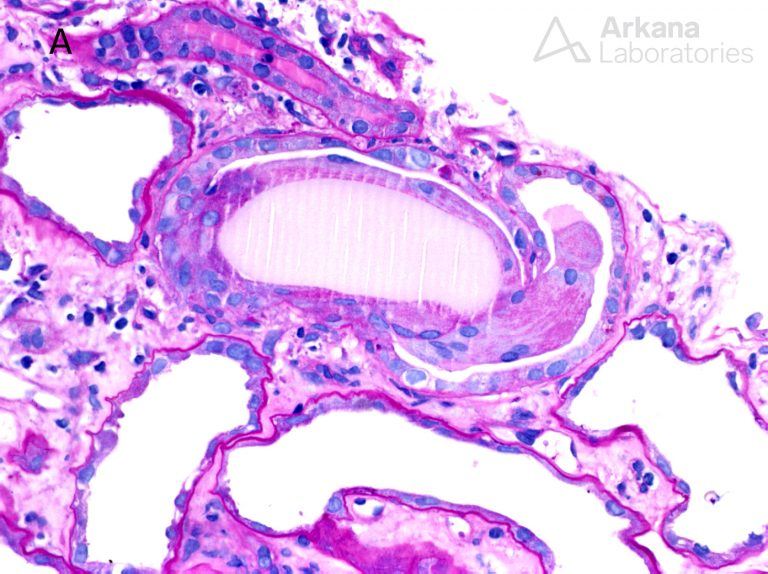 Tubular Cast Tutorial | Teaching Points | Arkana Laboratories
