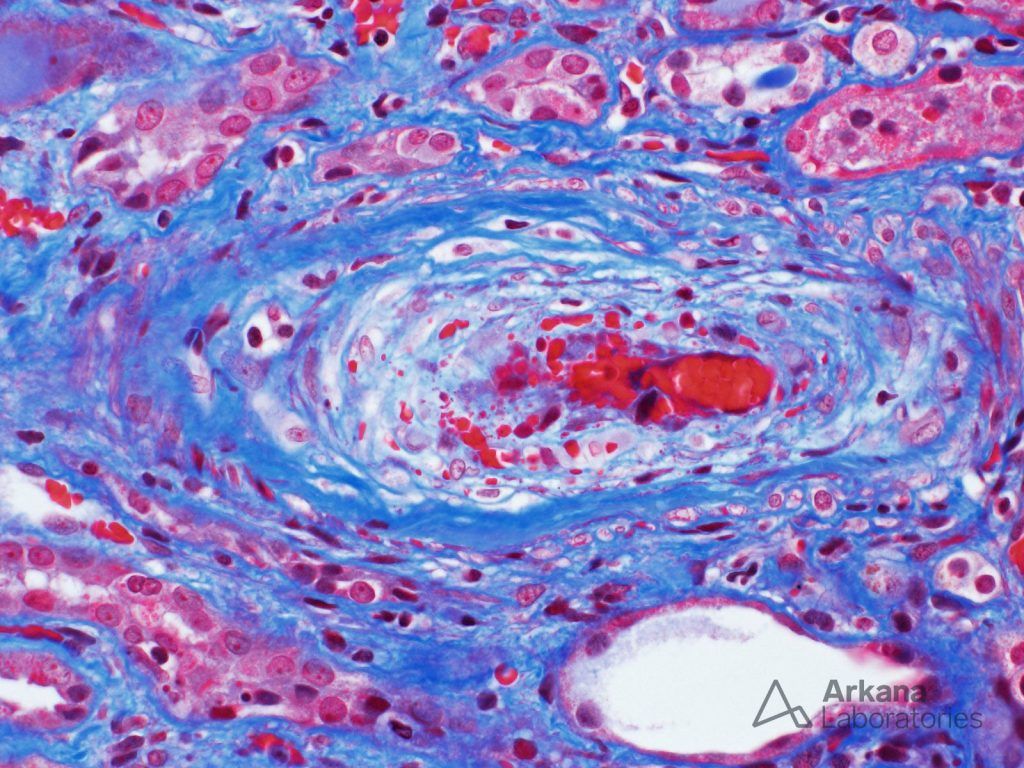 Thrombotic Microangiopathy | Teaching Points | Arkana Laboratories