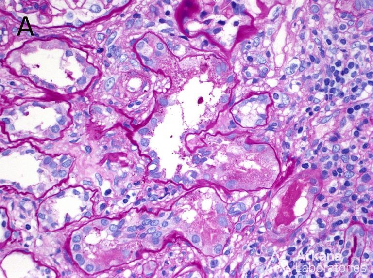 Nephronophthisis by Light Microscopy | Teaching Points | Arkana