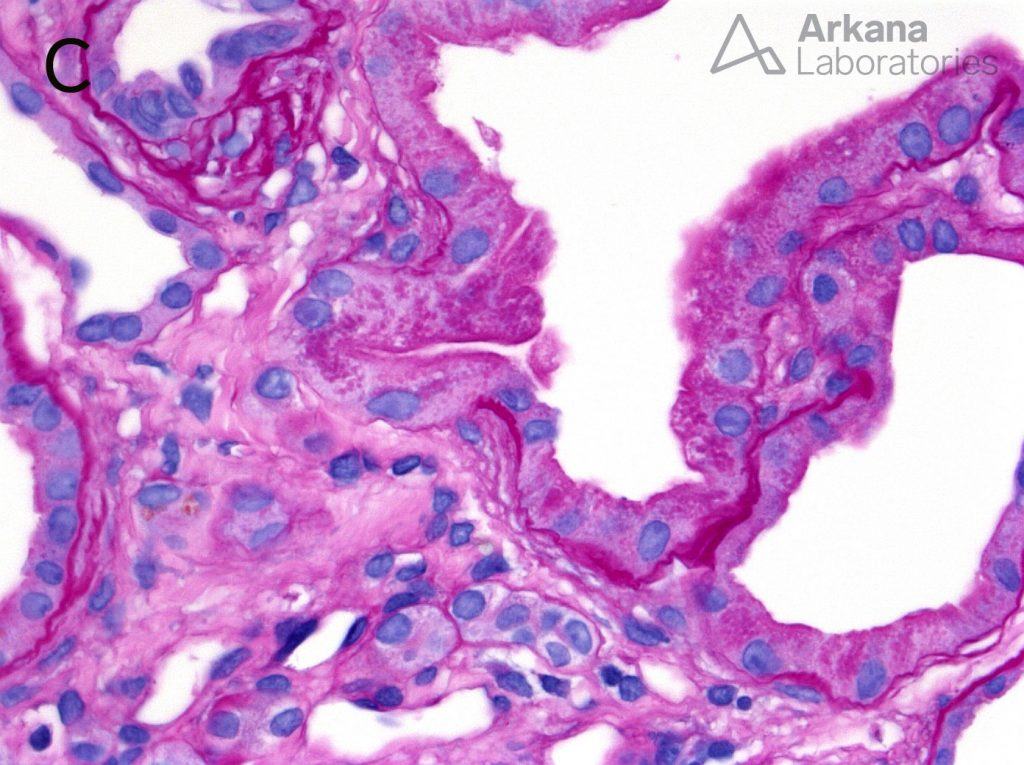 Nephronophthisis by Light Microscopy | Teaching Points | Arkana