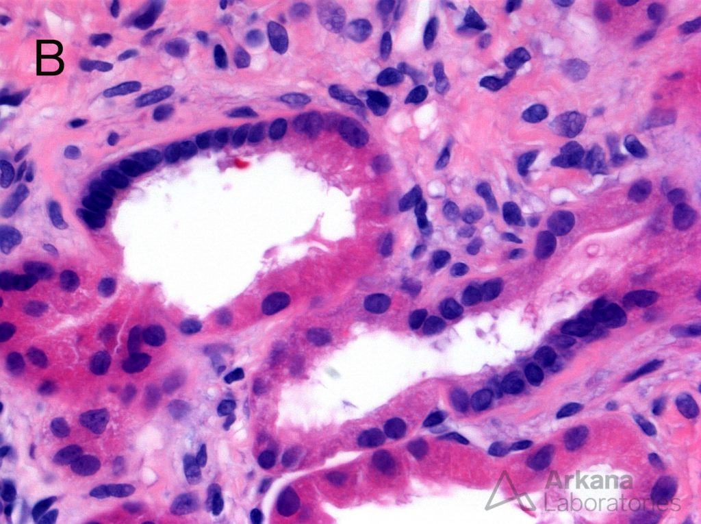 Nephronophthisis by Light Microscopy | Teaching Points | Arkana